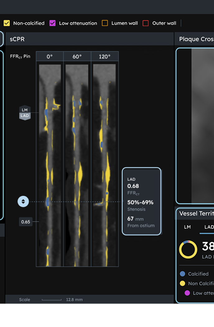 Plaque Analysis